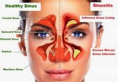 cara menyembuhkan sinusitis: Cara Menyembuhkan Sinusitis