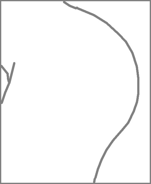 Skin Rejuvenation & Body Contouring Institute: Buttock Aesthetics