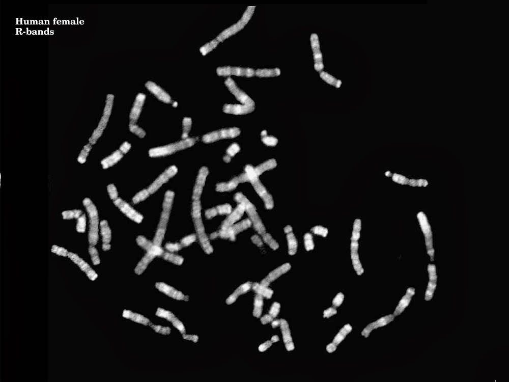 MONOSOMIA DEL 21: Estudio cariotipo