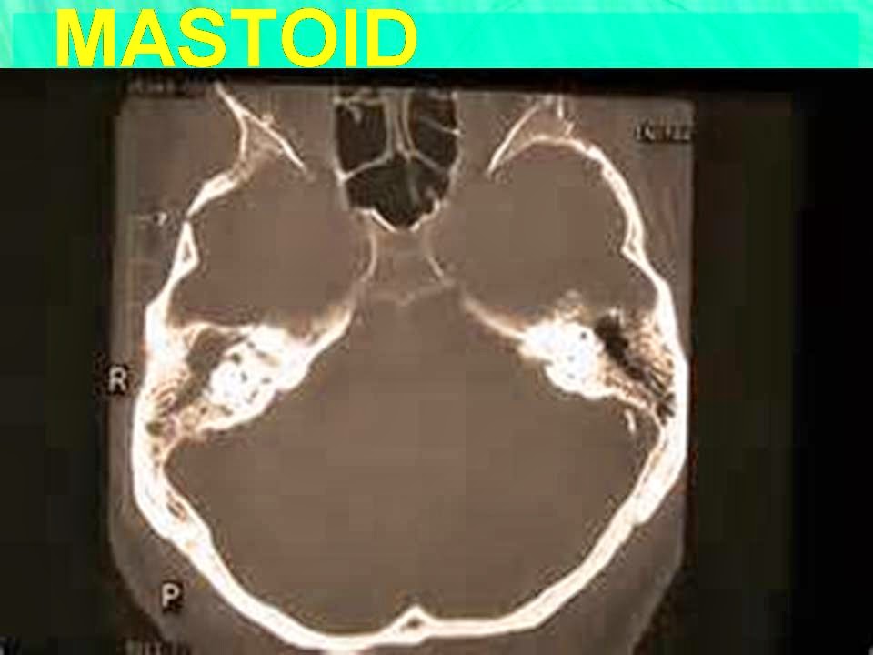 Pyothorax Without Fistula