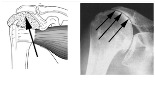 Shoulder Arthritis / Joint Replacement : Cuff tear arthropathy - does ...