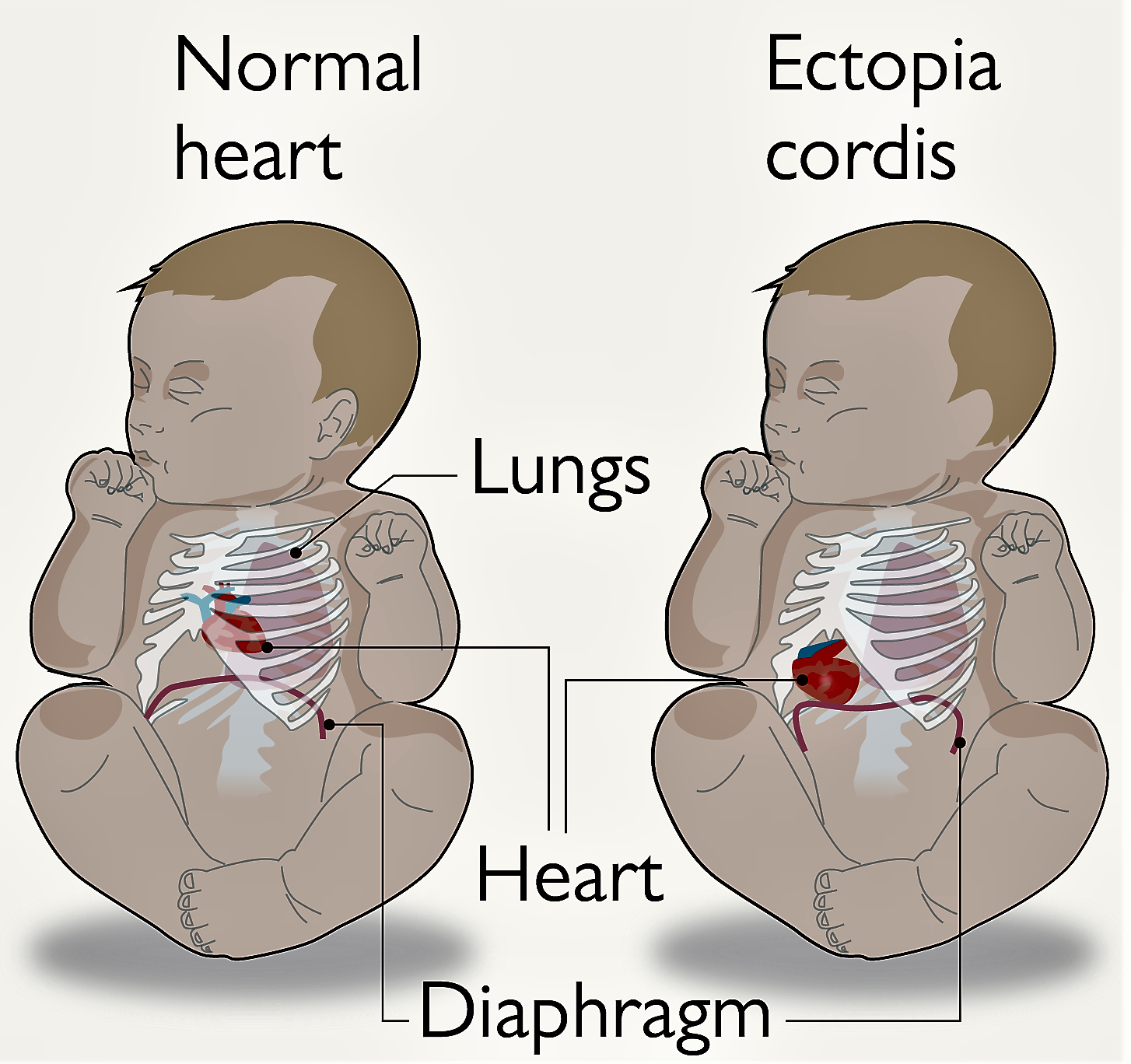 3rd Global Heart Congress Ectopia Cordis A Rare Heart Disease