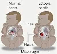 3rd Global Heart Congress: Ectopia Cordis - A Rare Heart Disease