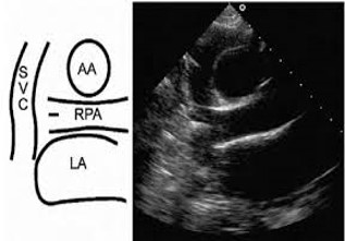CVT Mohd Farid: Basic Echocardiography:Transthoracic Echocardiography ...
