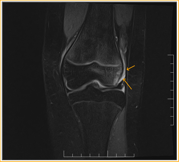 Lateral patellar dislocation - Sumer's Radiology Blog