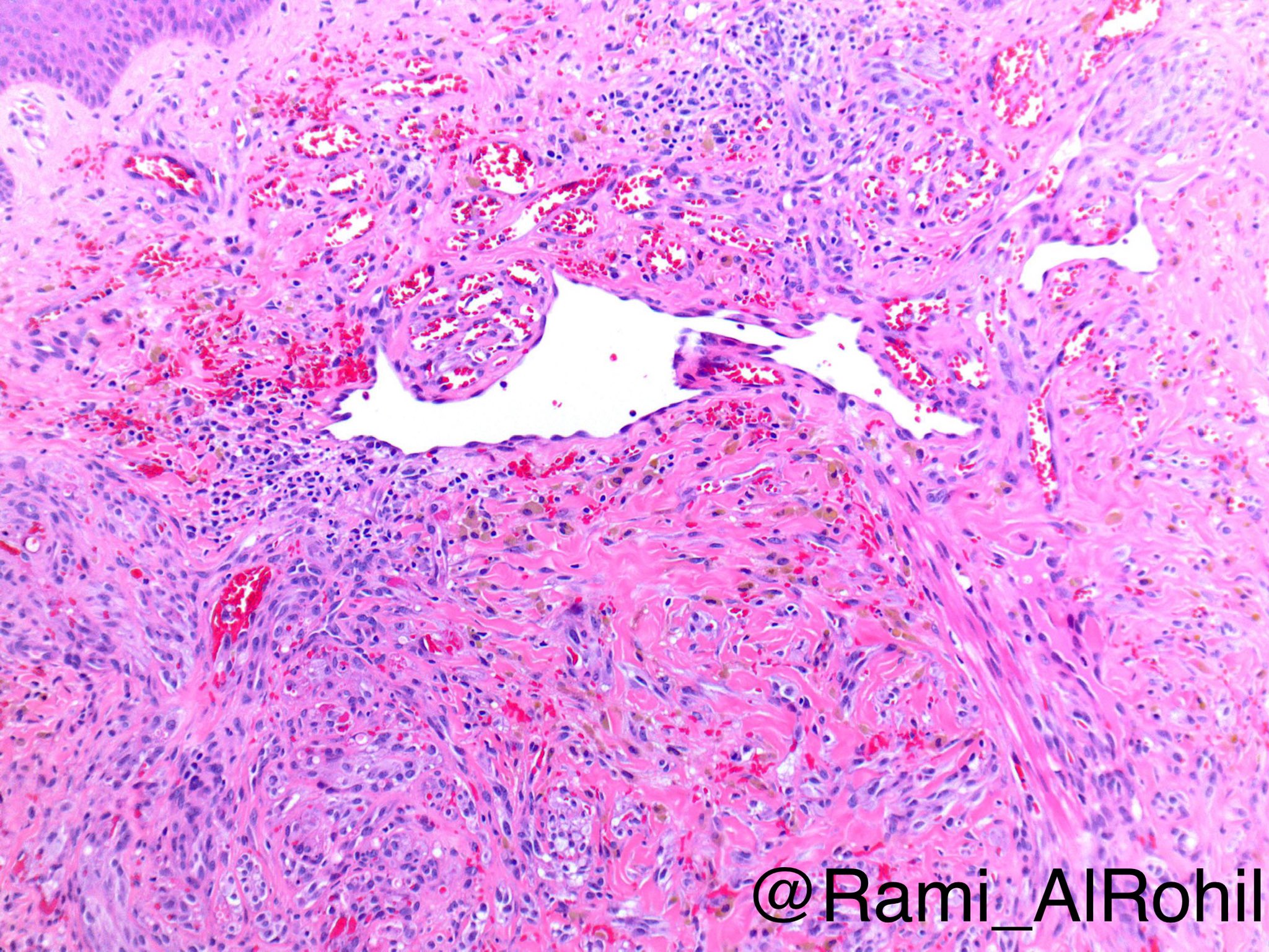 SARCOMA DE KAPOSI, EN PACIENTE ADULTO MAYOR HIV-