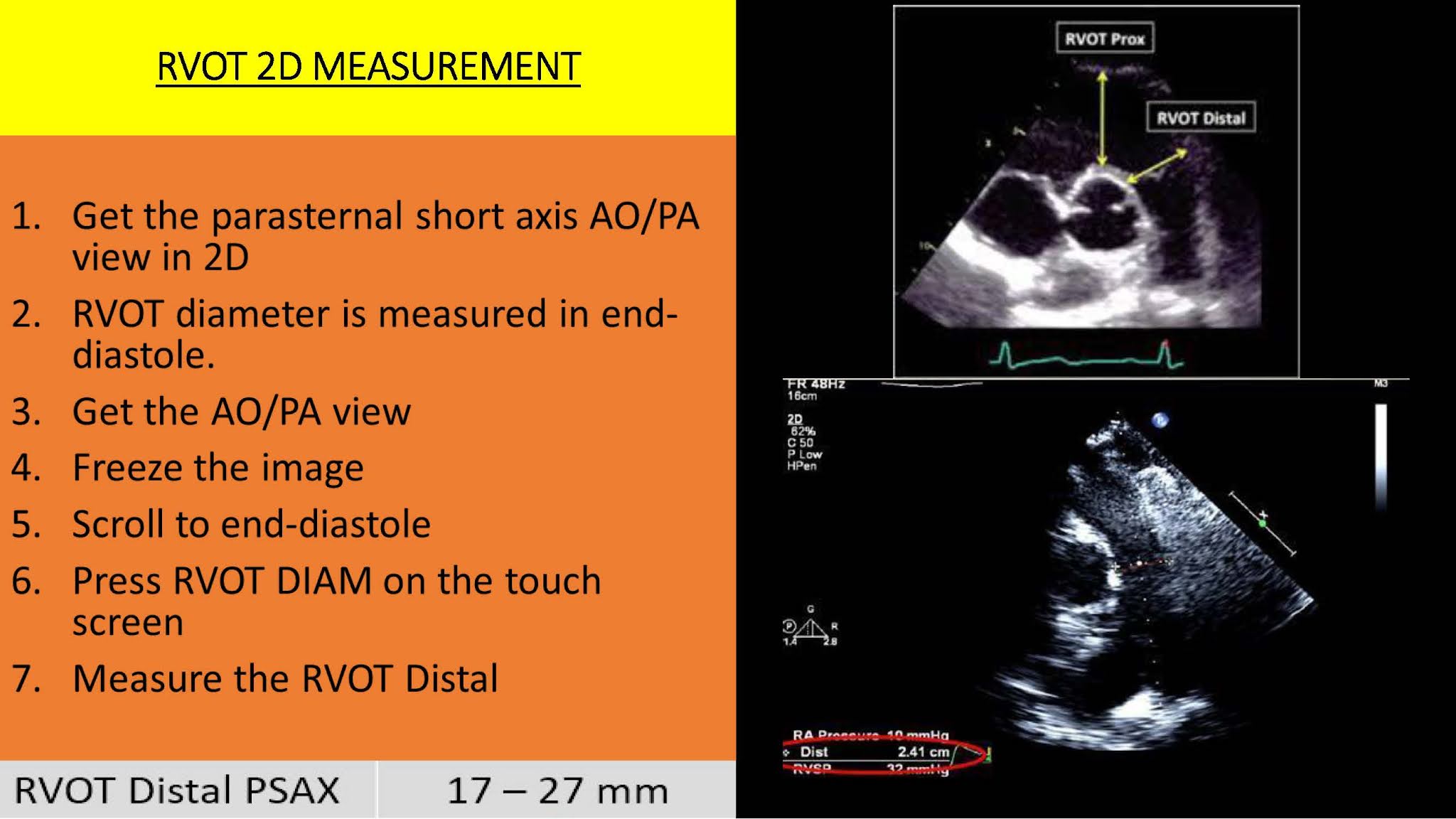 CVT Mohd Farid: Basic Echo Measurements And Values Nurain Jurnalis CVS Medical Part II