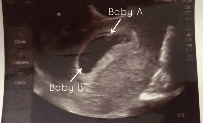 zack: Fraternal Twins Vanishing Twin Syndrome