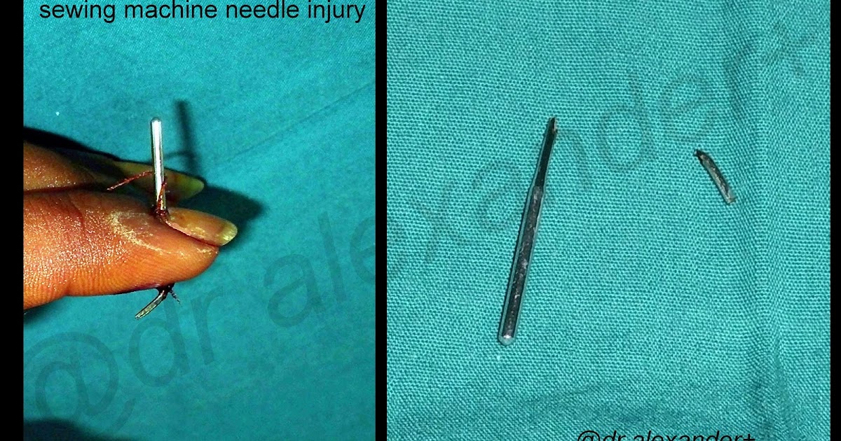 Cosmetic-Plastic Surgeon: Sewing machine needle injury, finger injury ...
