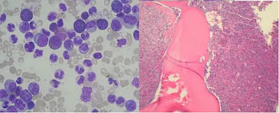 Chronic Myeloproliferative Neoplasms (MPN)- Chronic Myeloid Leukemia (CML)