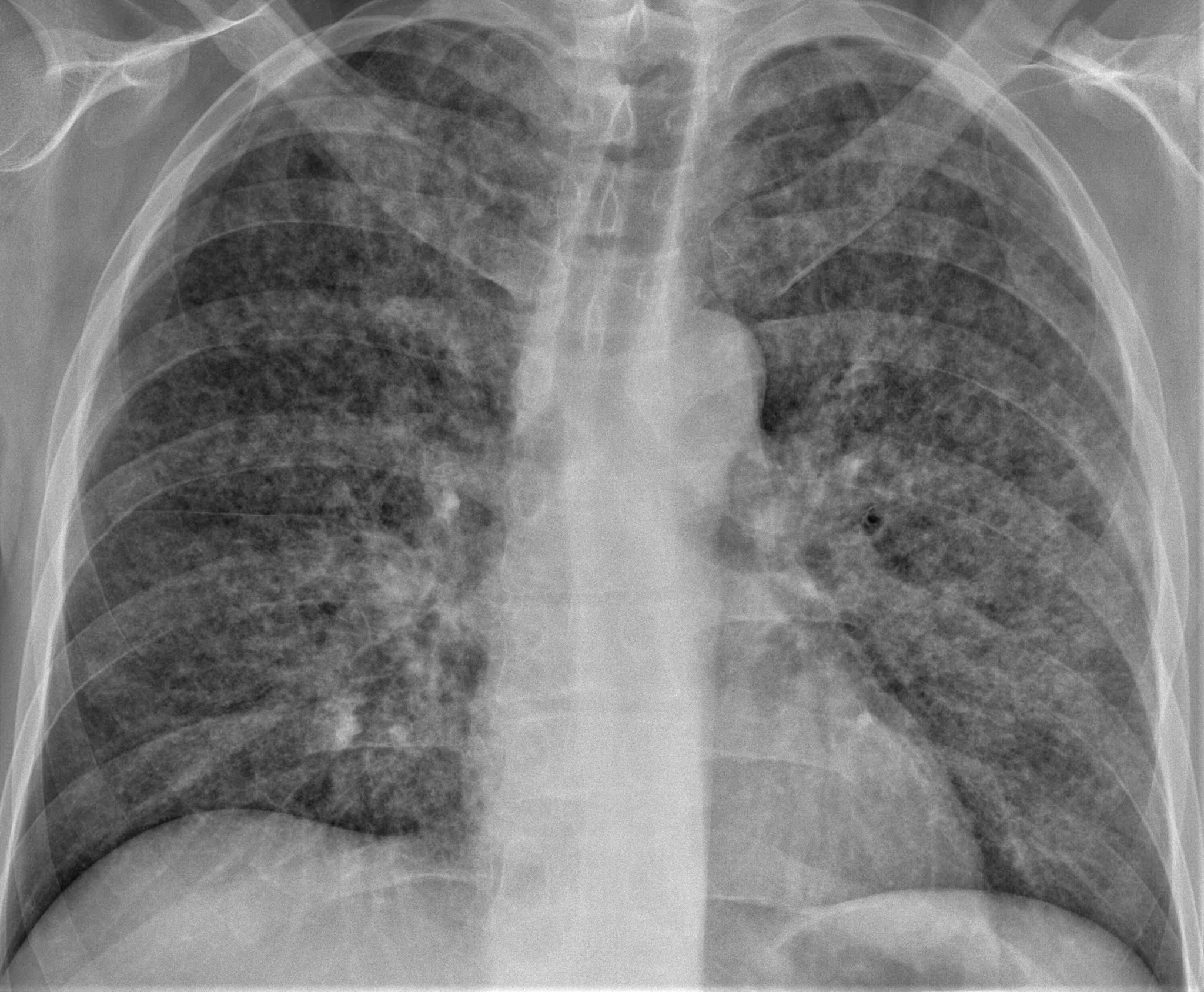 HISTOLOGÍA un enfoque clínico: TUBERCULOSIS