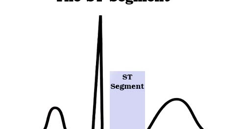 How to read an Electrocardiogram (ECG) - Part 6, The ST Segment ...
