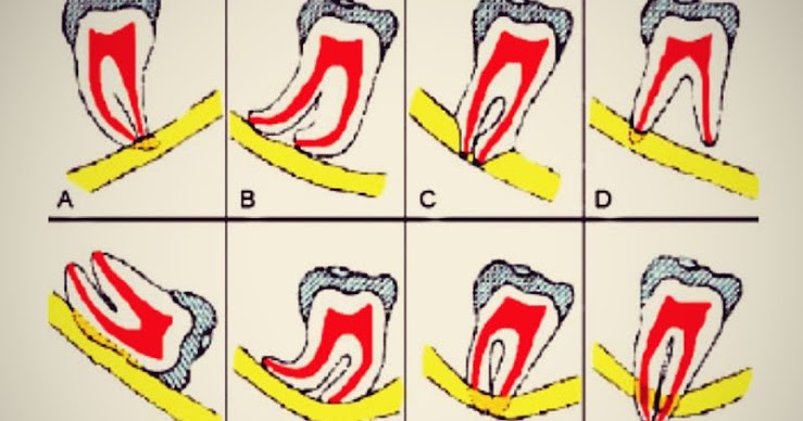 PDF: Actitud ante una posible parestesia del nervio dentario inferior ...