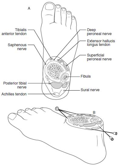 Anesthesia for Lower Extremity Surgery (Peripheral Nerve Block) Case File