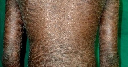 (MUST READ) New Deadly STD Causing Great Damage To The Skin