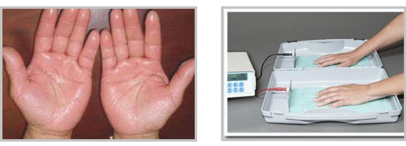 IIAM Groups of Skin,hair & laser clinic: HYPERHIDROSIS (SWEATING)