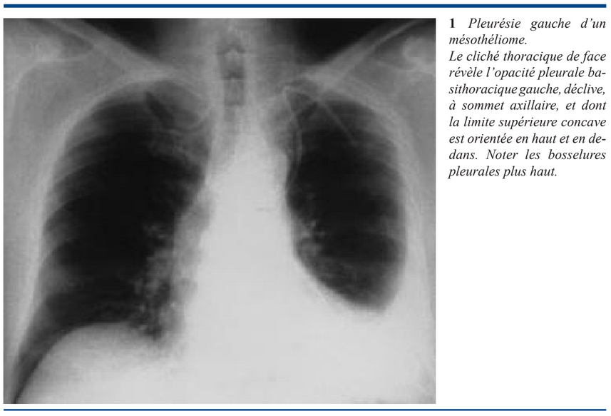 Pleurésies - Documents de Médecine