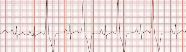 Basic EKG Rhythm Test 02