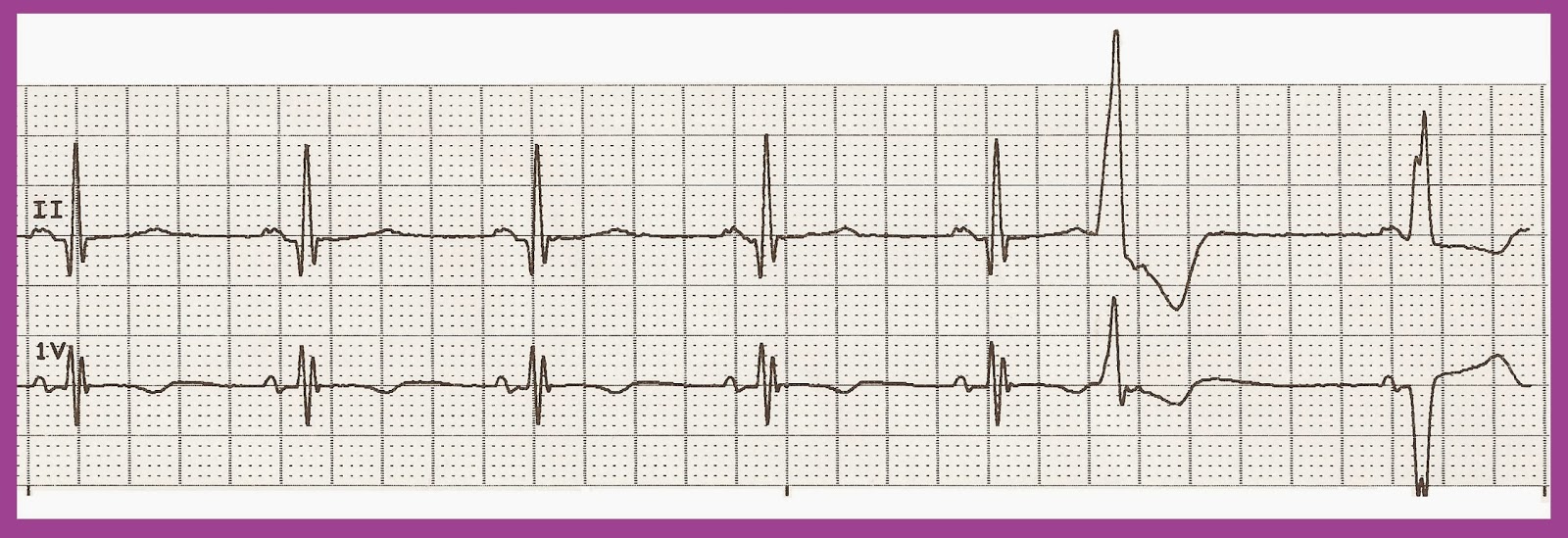 EKG Rhythm Strip Quiz 206