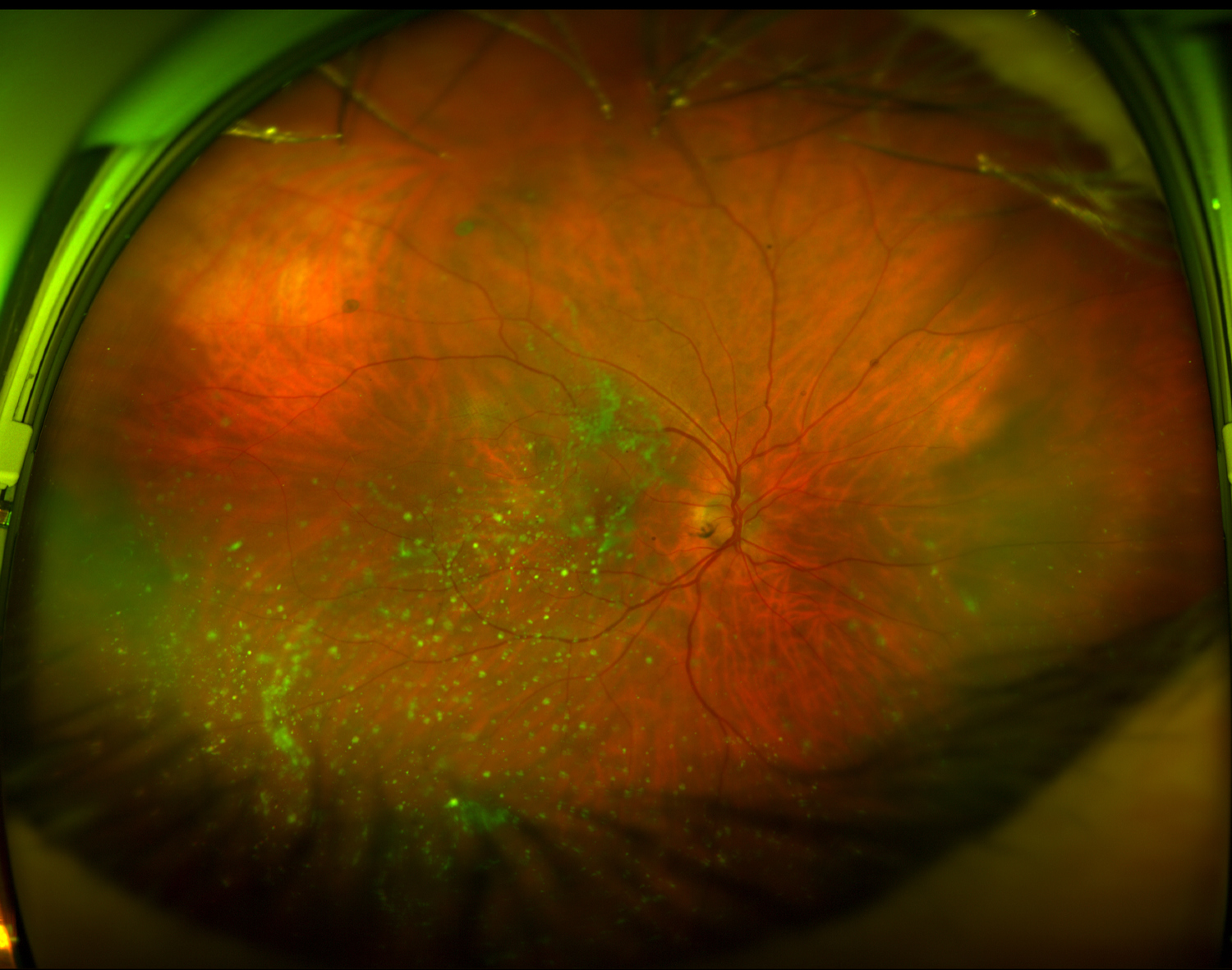 What The Fundus? New Website for Sharing Optos Retinal Images - Eyedolatry