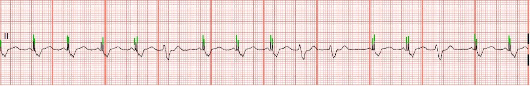 EKG Rhythm Strip Quiz 66
