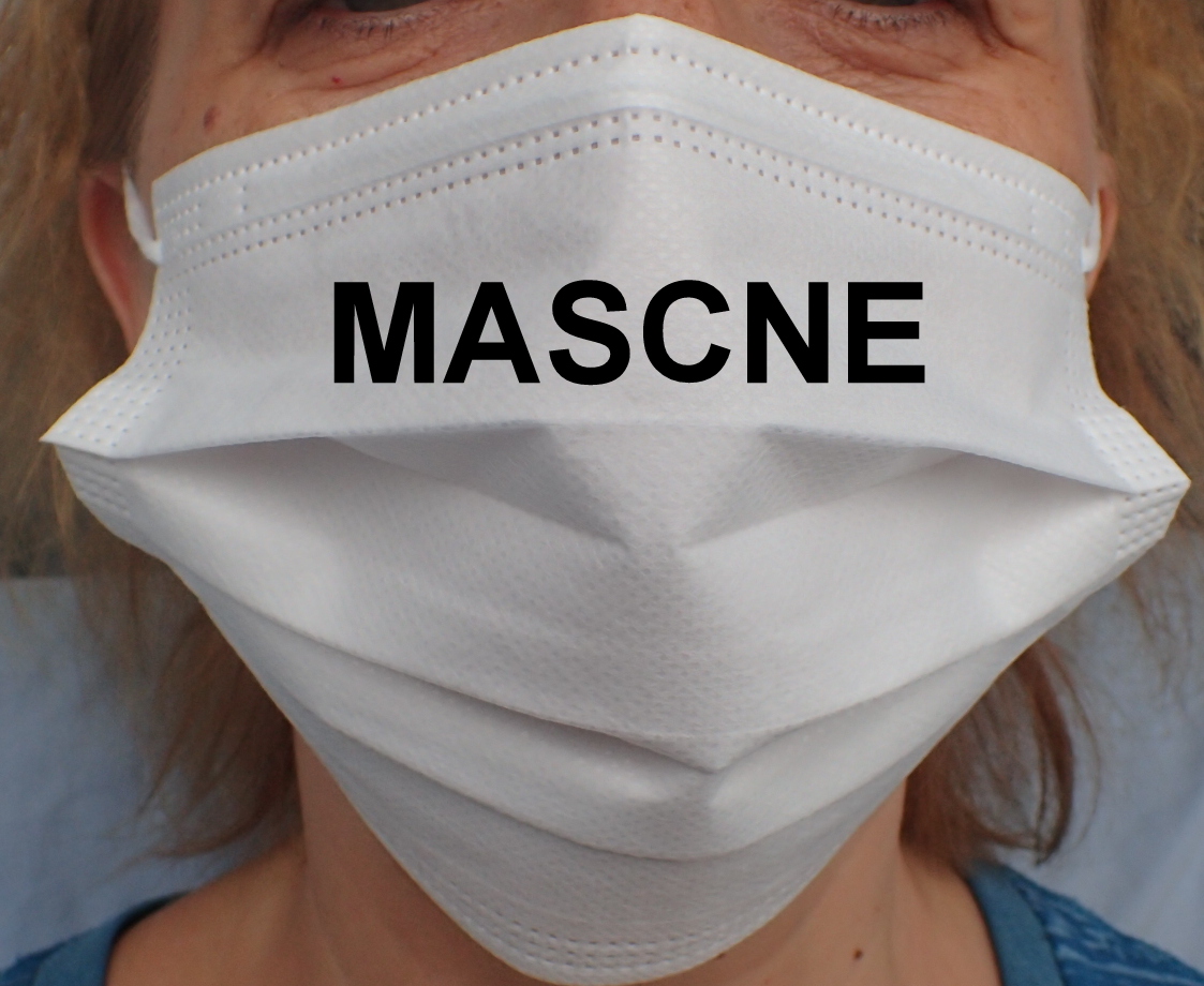 Biochemia Urody: MASCNE - trądzik maseczkowy.