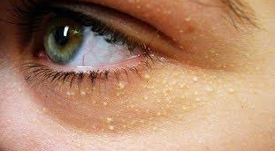 How To Remove Small White Skin Cysts Easily In Home - Health And Recipes