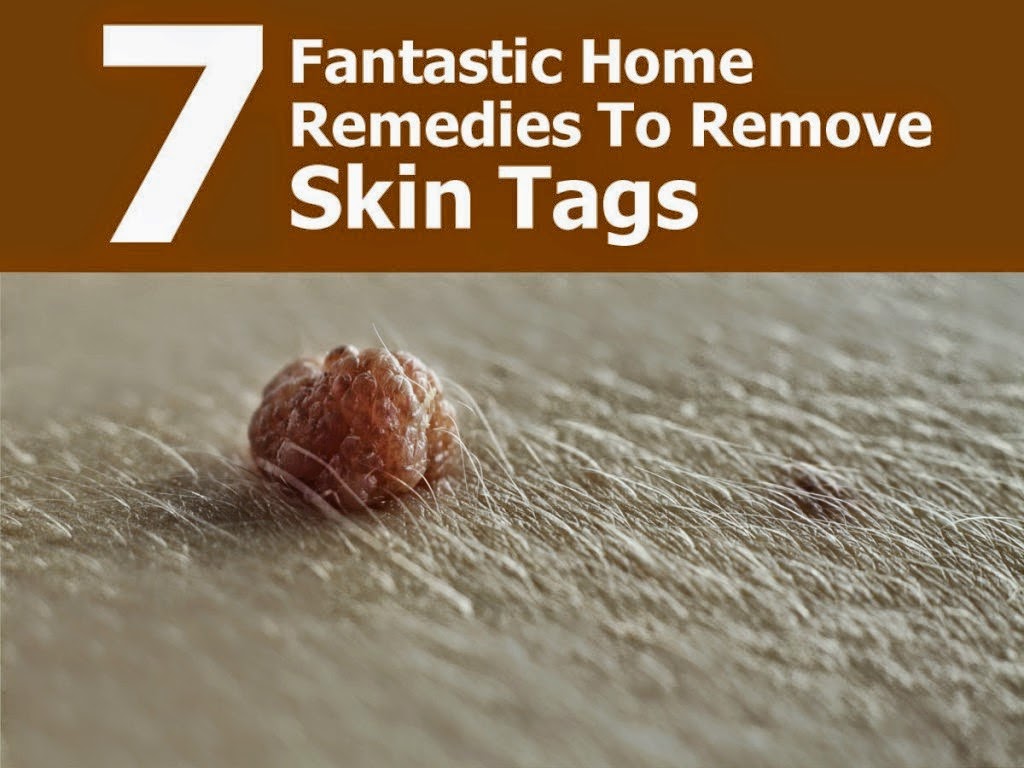 7 Fantastic Home Remedies To Remove Skin Tags - Handy DIY