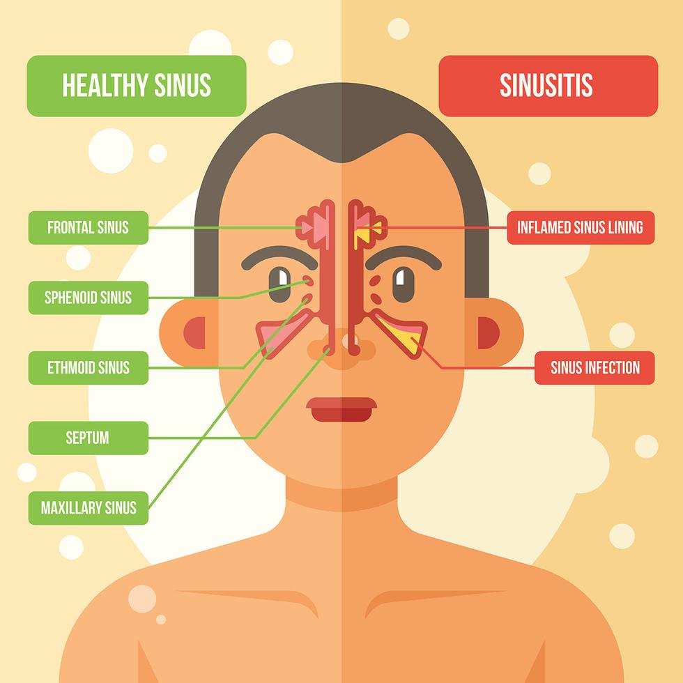 Signos y Síntomas | SINUSITIS Signos y Síntomas | SINUSITIS