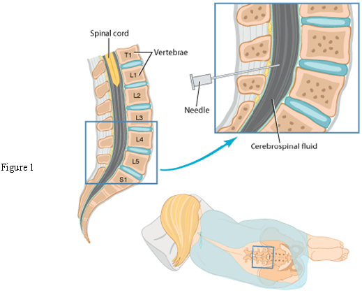 Update On Current Medicine: Lumbar Puncture
