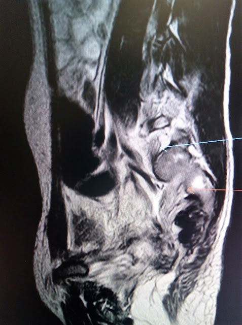 Chronic inflammatory demyelinating polyradiculoneuropathy (CIDP): MRI ...