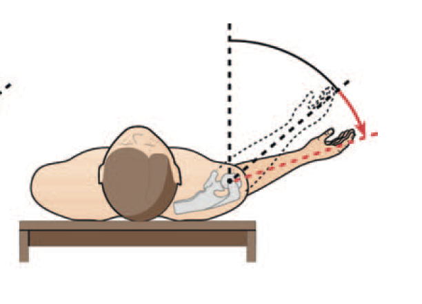 UW Shoulder and Elbow Academy: Subscapularis failure after shoulder ...