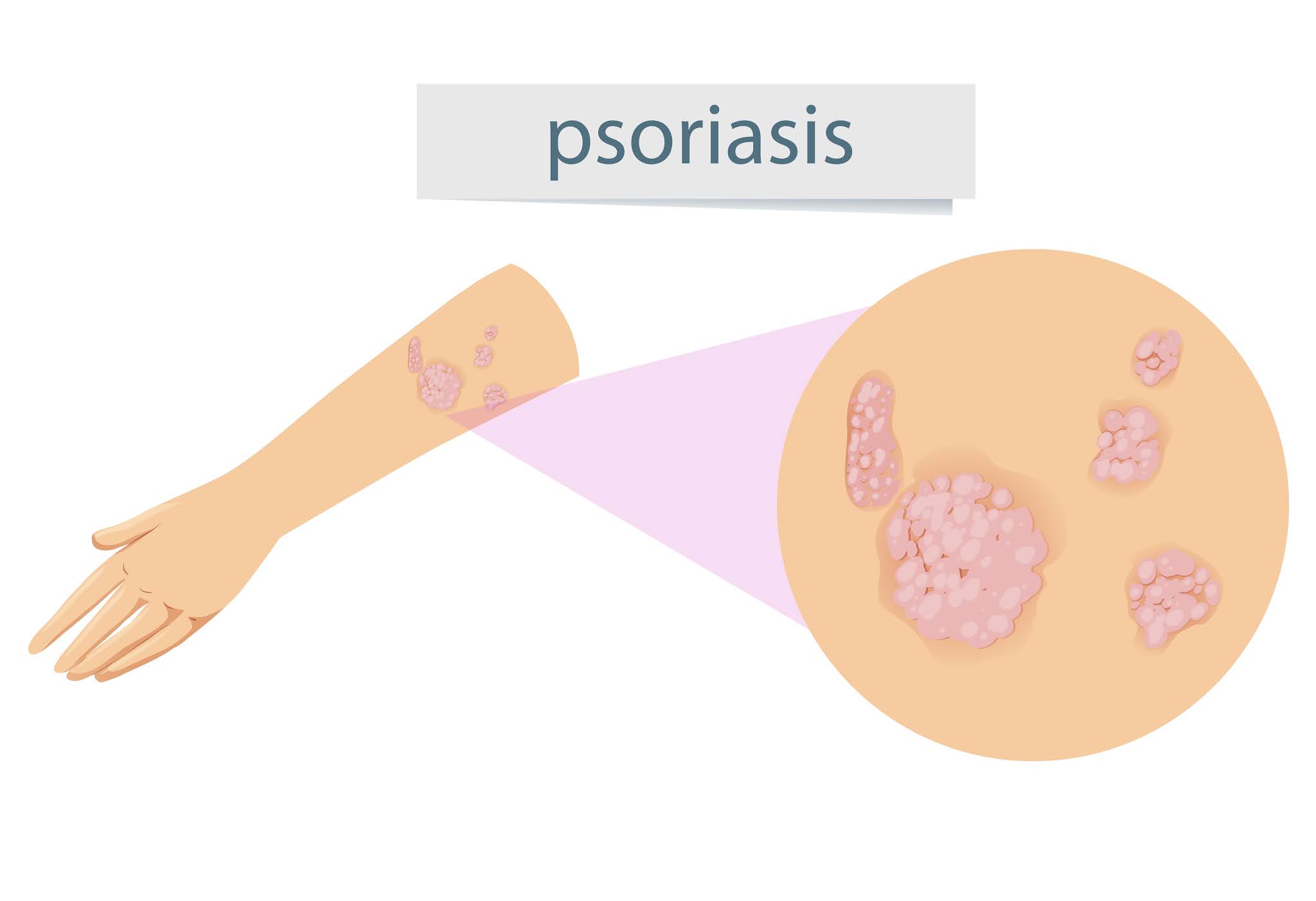 Psoriasis - Salud en línea