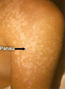 Petua Untuk Menghilangkan Panau, Kurap dan Kudis Buta.. - Product Report