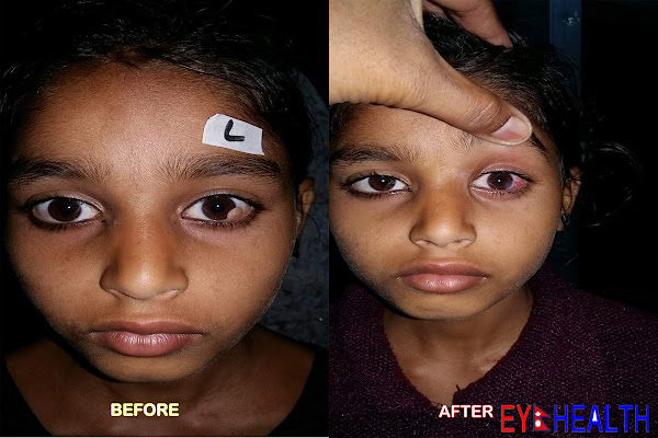 Before and After Photo of Limbal Dermoid Excision Surgery - Eye Health ...