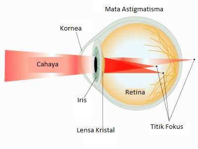 Selamat Datang Di Klinik Jerry: 2b. Penyakit Mata Silinder (Astigmatisma)