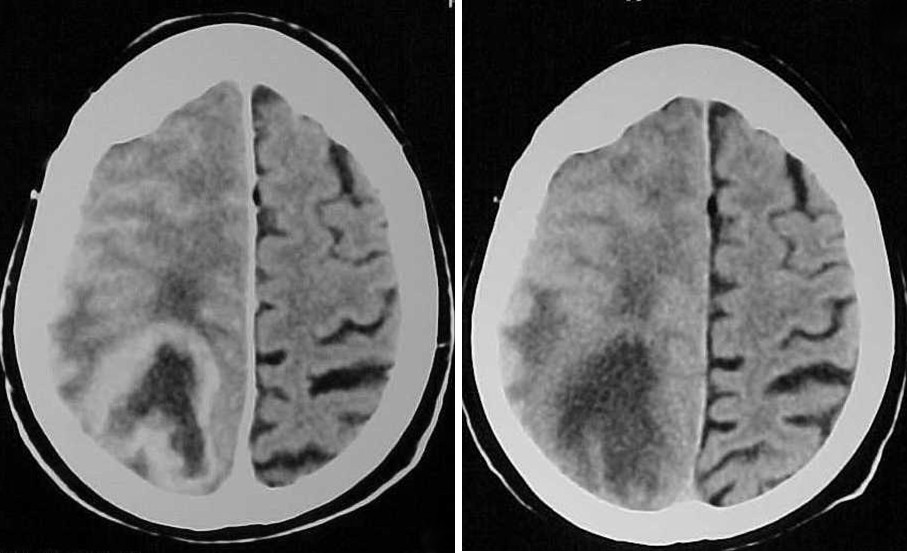 Cancer cerebral Astrocitoma | Vivir con cancer