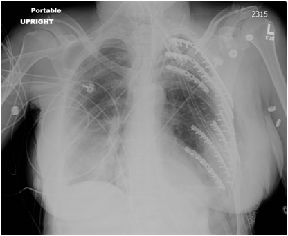 TITANIUM RIB PLATING: PHOTOS OF MY SURGERY & VIDEO