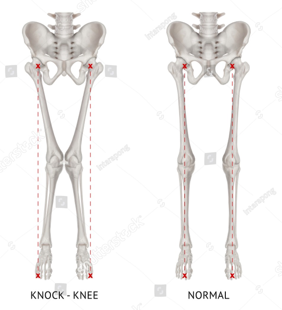 POSTURAL DEFORMITIES