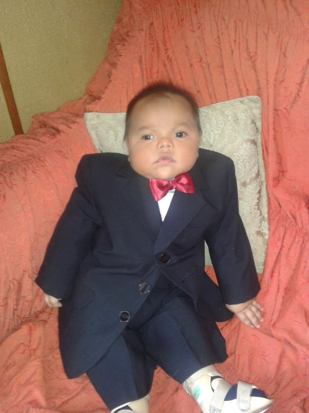 Pie Equino Varo - Pie Bot - Perú: abril 2013