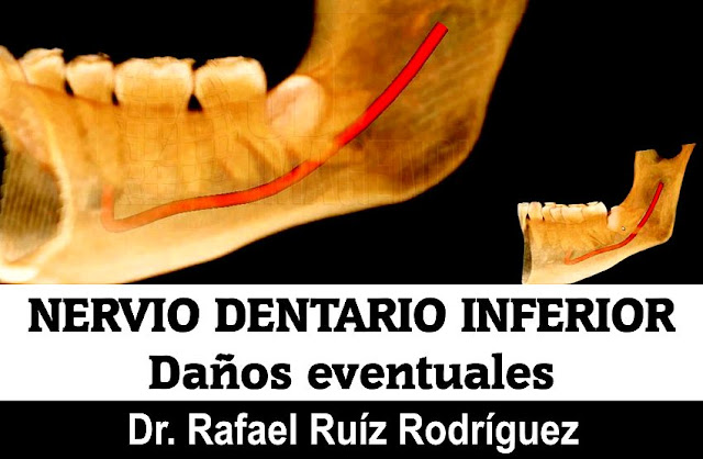 NERVIO DENTARIO INFERIOR: Daños eventuales - Dr. Rafael Ruíz Rodríguez
