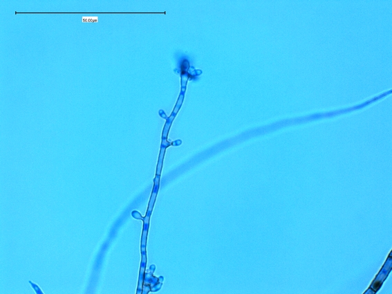 Fun With Microbiology (What's Buggin' You?): Fonsecaea pedrosoi/monophora