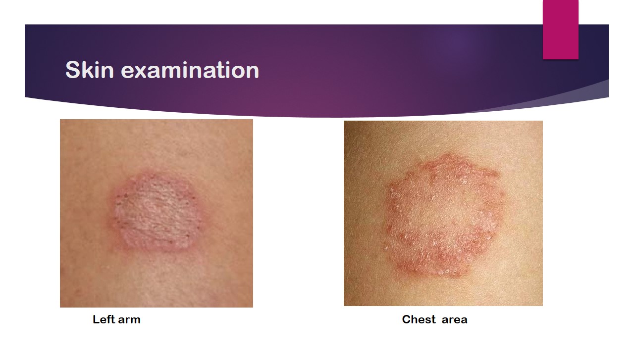 The Family physician : Case Presentation: Tinea Corporis