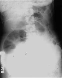 My Radiology World: Volvulus