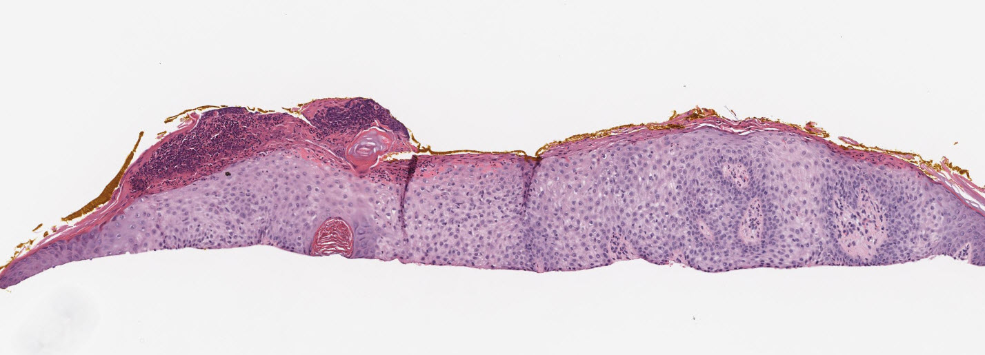 Differential Diagnosis in Dermatopathology: Pale cells in the epidermis