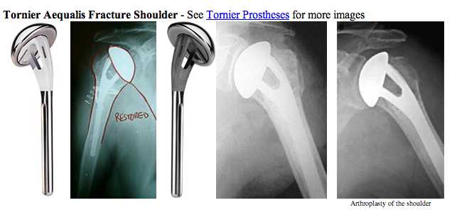Shoulder and Elbow Surgery: Identifying the implanted shoulder ...
