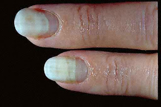 Wellness Lab Health Info: Fingernails: 5 Signs That Point to Bigger ...