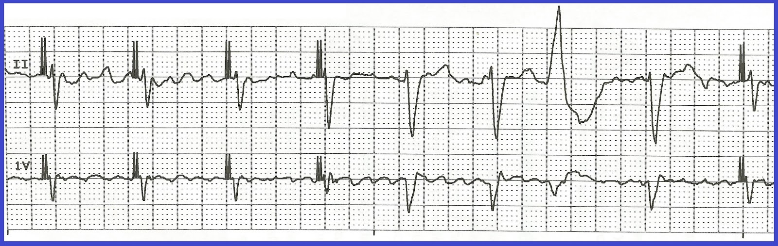 Biventricular Pacemaker