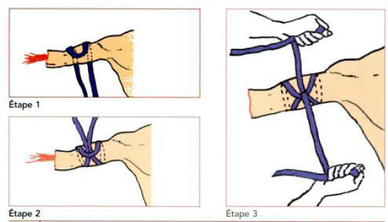 IDEcours: Gestes Pratiques en cas d'une Hémorragie En Urgence