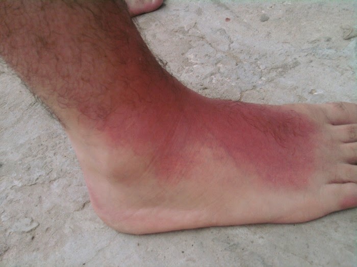 MANEJO DE #PACIENTE #QUEMADO EN 8 PASOS